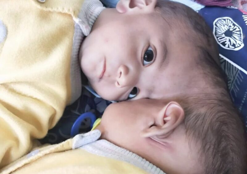 Conjoined Twins with Fused Brain Structures Successfully Separated ...
