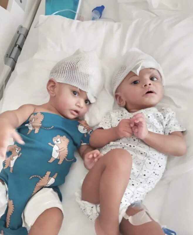 Conjoined Twins with Fused Brain Structures Successfully Separated ...